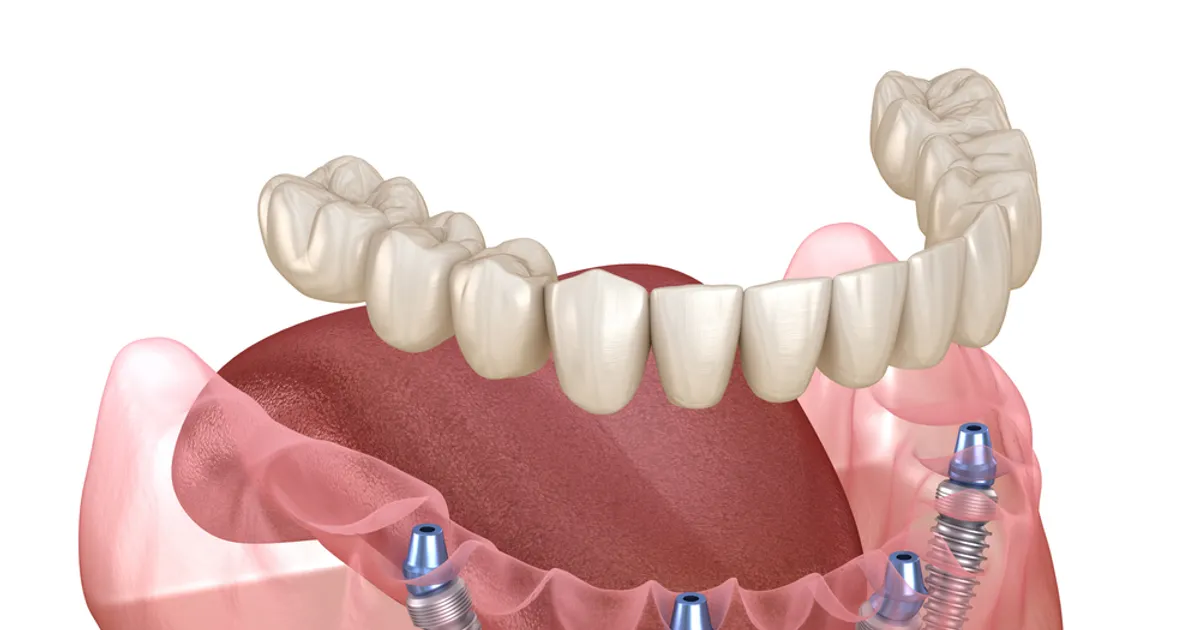 Transform Your Smile With Affordable All on 4 Dental Implants - Nation.com
