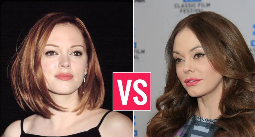 Celebrities With Plastic Surgery: Better Before Or After? - Fame10