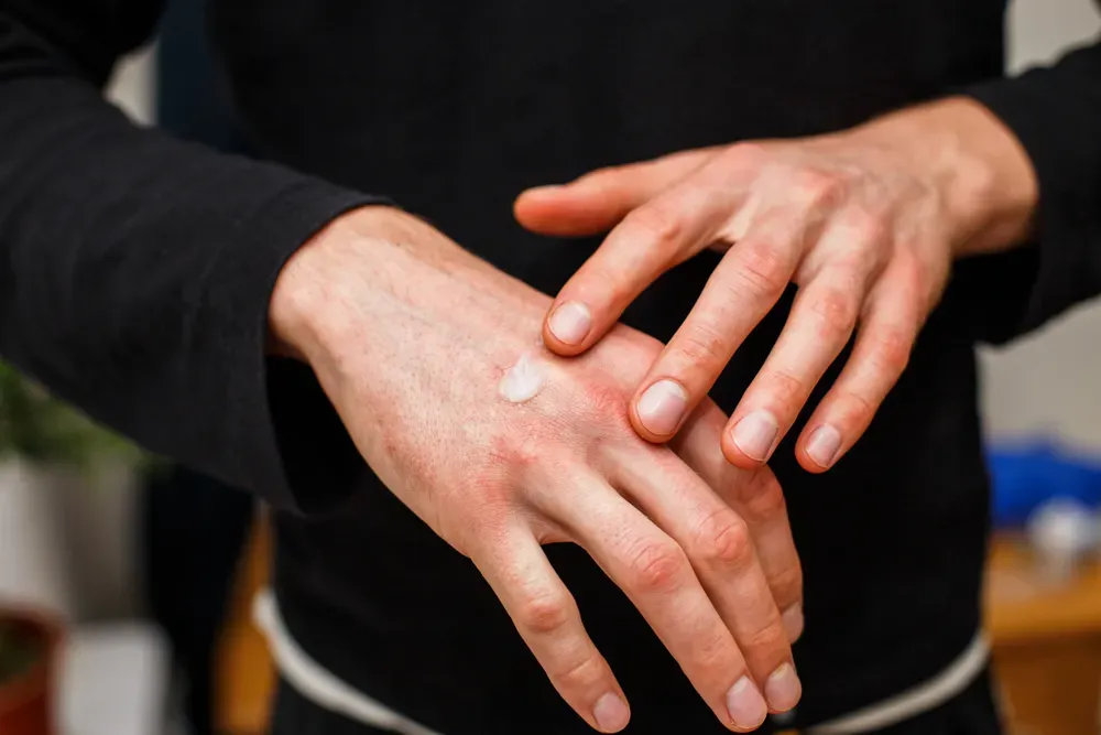 Exploring Moderate Atopic Dermatitis Symptom Treatment Helpme