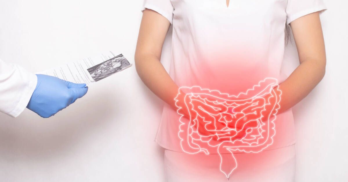 What You Need To Know About Ulcerative Colitis Early Signs And
